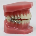 Herbst beugel om overbeet herstellen? Orthodontie Eemland